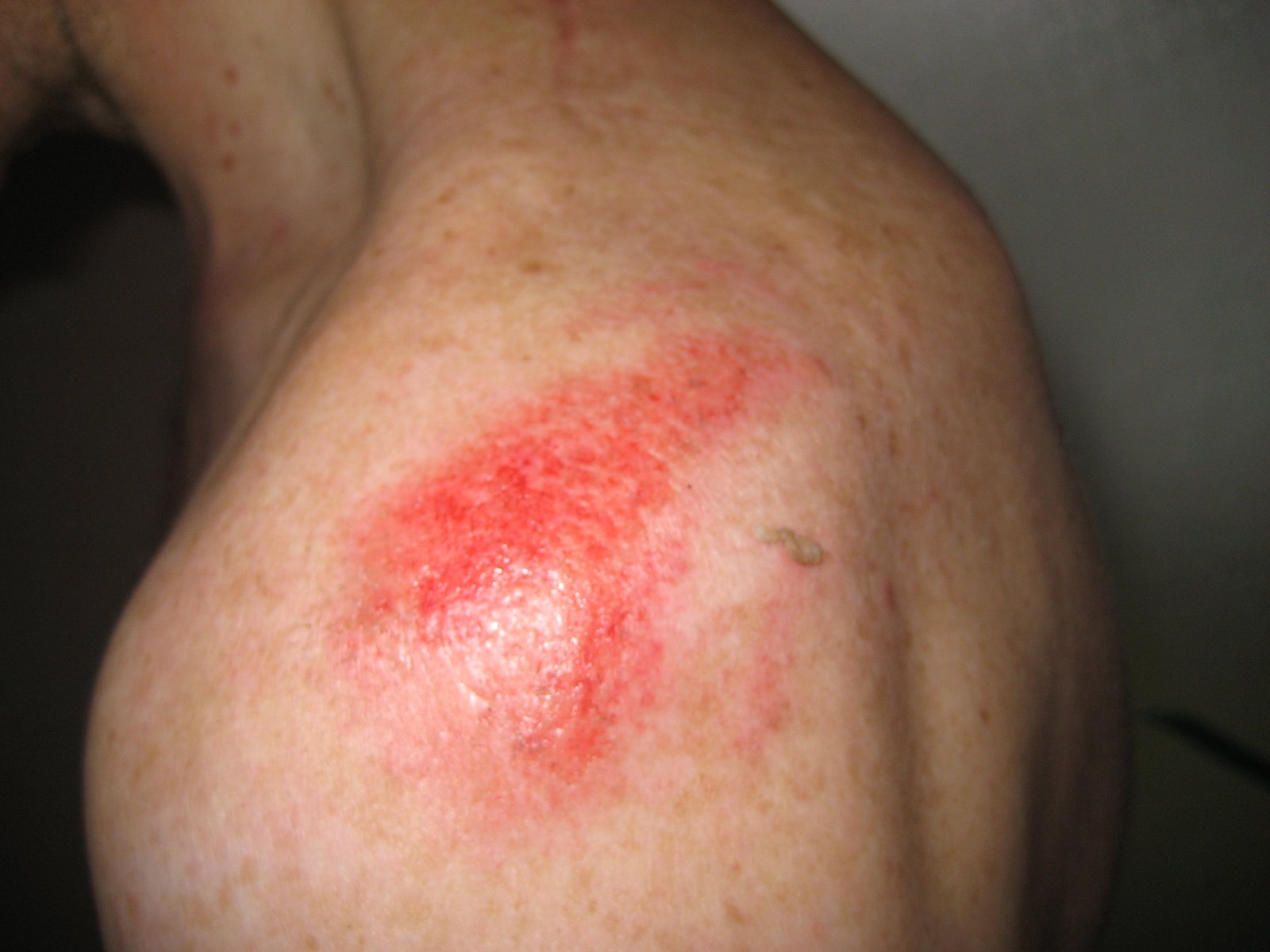 Can You Get Gout In Your Shoulder