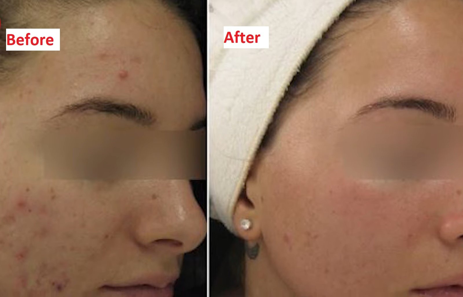 Micro Needling Before and After: A Complete Guide - CloudMineInc