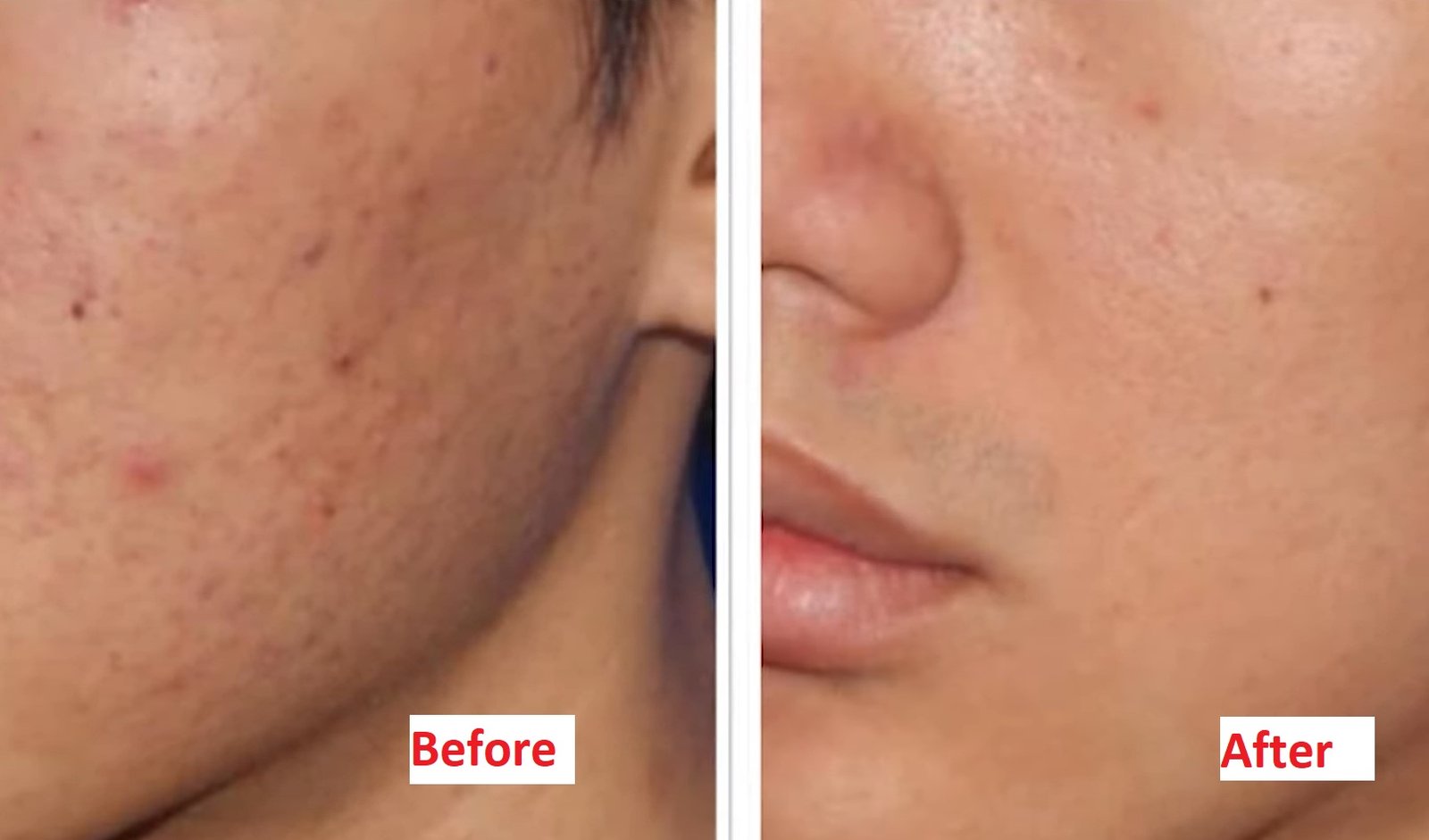 Micro Needling Before and After: A Complete Guide - CloudMineInc