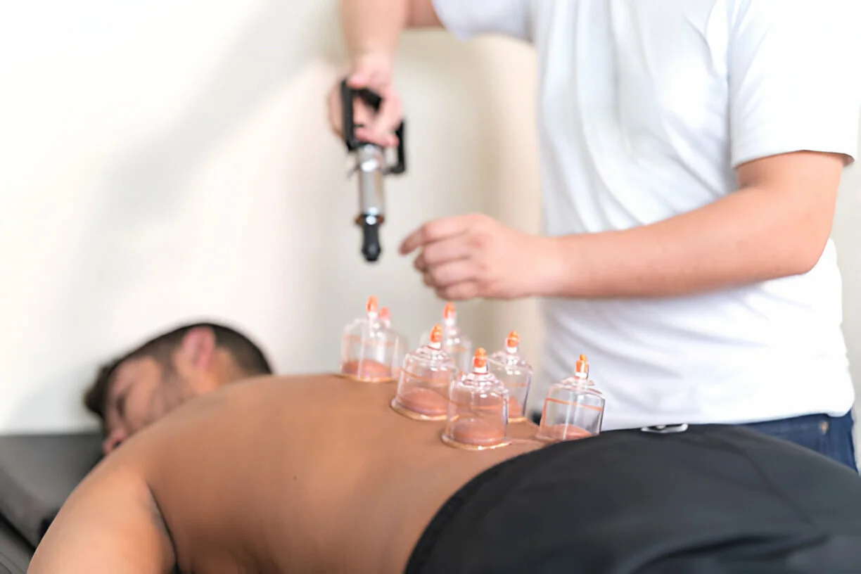 Acupuncture And Cupping: Enhancing Athletic Performance - CloudMineInc